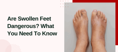 Are Swollen Feet Dangerous? What You Need To Know