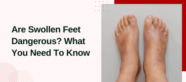Are Swollen Feet Dangerous? What You Need To Know