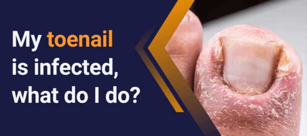 My toe is infected (Ingrown toenail), What do I do?
