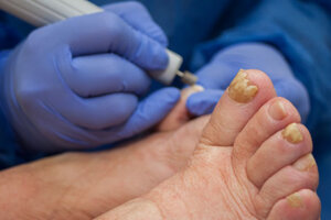 Urgent Care for Stubbed Toe Infection Treatment | Stubbed Toe Care